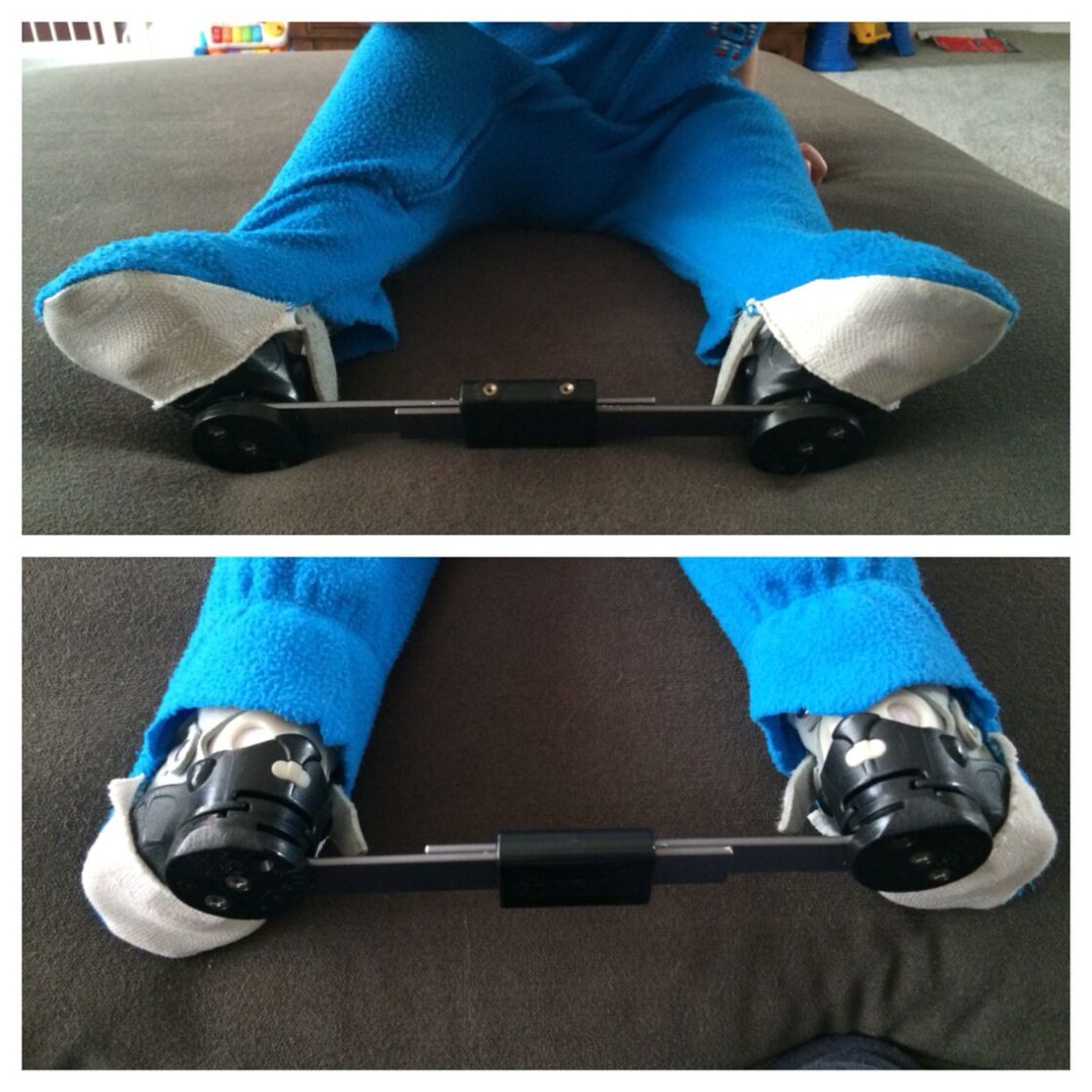 Is There Assistive Technology to Help Clubfoot in Children? - AWS Rails