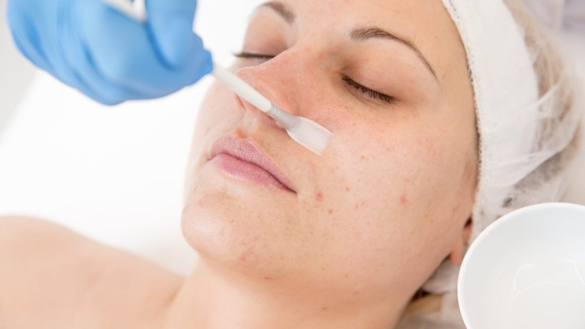 Types and Procedure for Chemical peels - AWS Rails