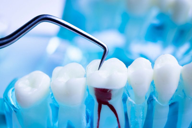 How Much Does a Root Canal Cost With and Without Insurance? - AWS Rails